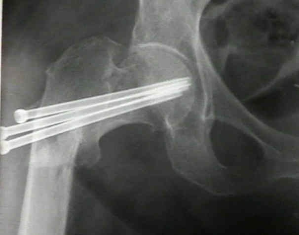 정형외과 수술의 종류-허리.고관절, 무릎,손등-본문공유 : 네이버 블로그