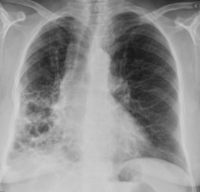 기관지확장증, 임상 특징과 흉부 엑스레이, Bronchiectasis, clincal features and chest X ...